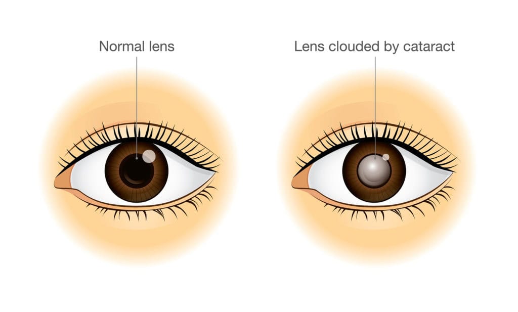 Eye Vitamins and Natural Vision Improvement Techniques