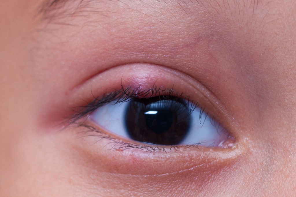 Natural Remedies: Styes, Night Blindness, and Uveitis