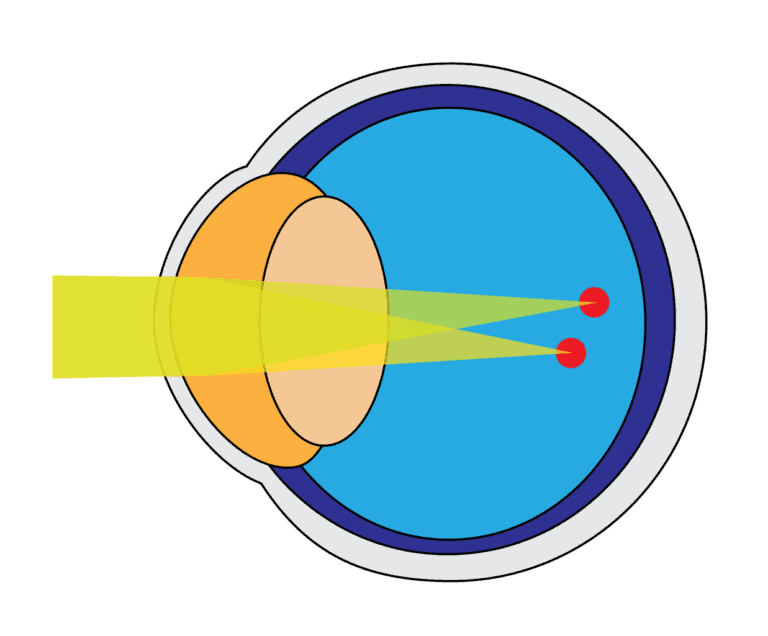 Eye Exercises for Astigmatism