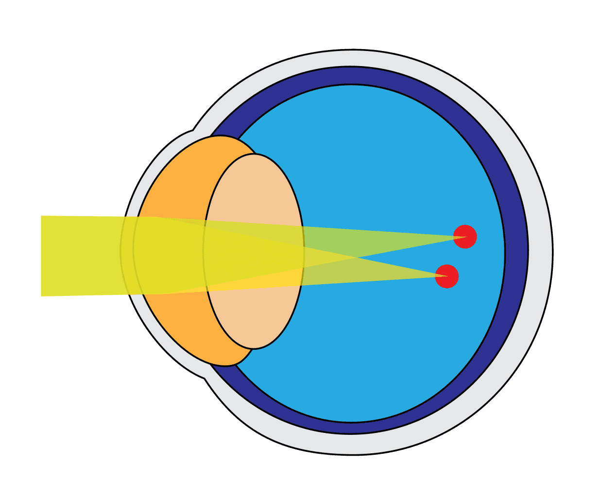 Eye Exercises for Astigmatism